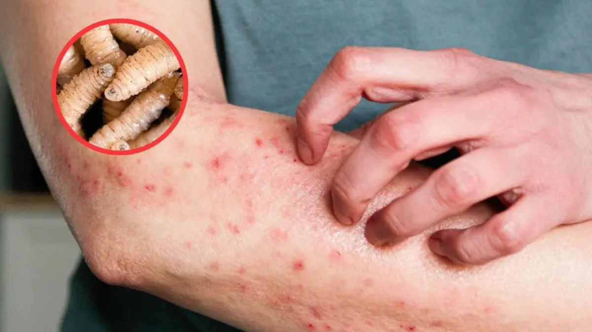 Se confirma el primer caso humano de miasis en México. - Las Noticias ...